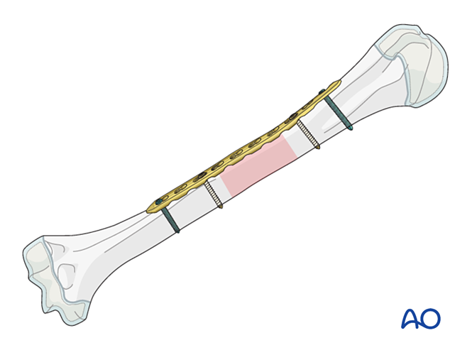 Open reduction - Bridge plating for Multifragmentary complete fracture