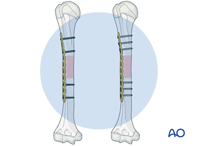 Open reduction - Bridge plating for Multifragmentary complete fracture