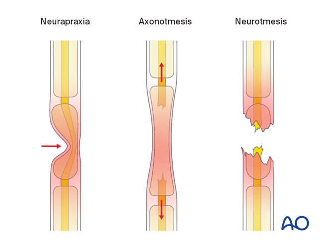 Management of associated radial nerve injuries