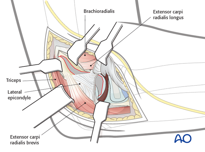 Lateral approach to the pediatric distal humerus