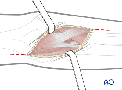 Anterior approach to the pediatric distal humerus