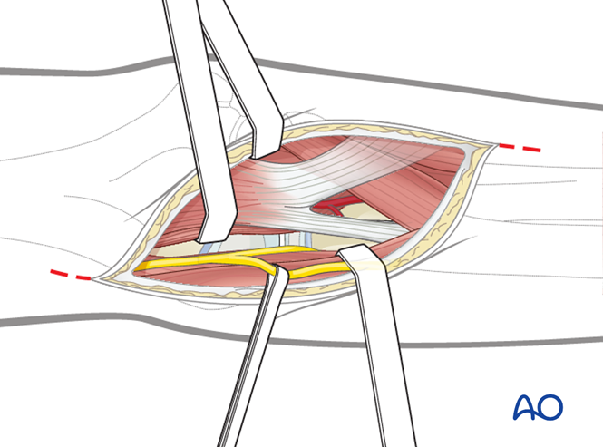 Anterior approach to the pediatric distal humerus