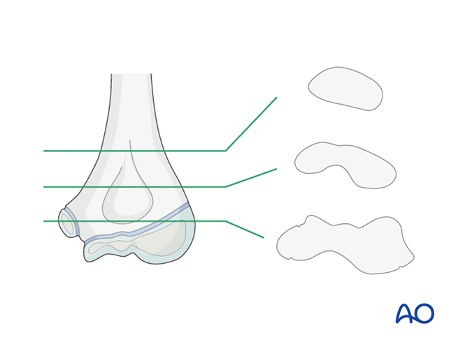 Distal humeral surgical and developmental anatomy