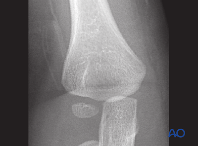 Distal humeral surgical and developmental anatomy