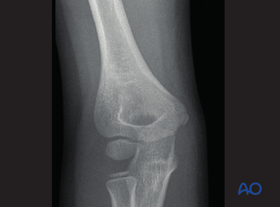 Distal humeral surgical and developmental anatomy