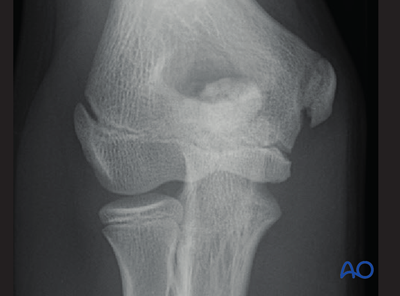 Distal humeral surgical and developmental anatomy
