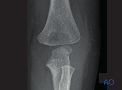 Simple epi-/metaphyseal, lateral condyle, SH IV