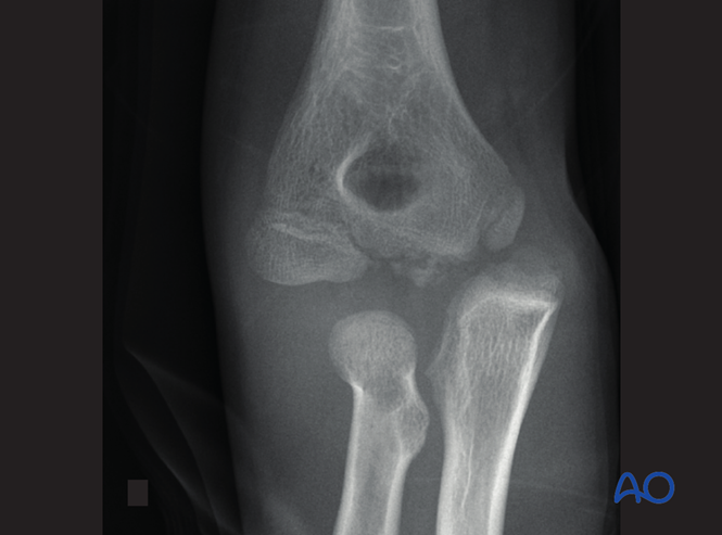 Avulsion of/by the lateral collateral ligament