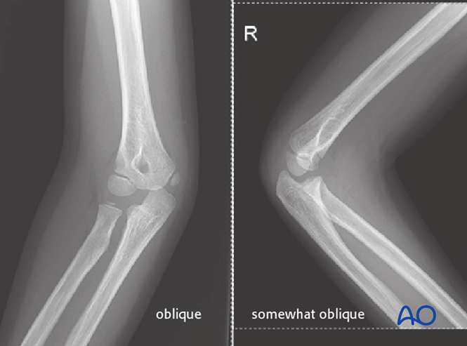 Simple epi-/metaphyseal, lateral condyle, SH IV