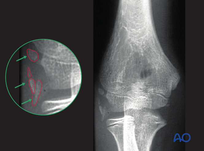Avulsion of/by the lateral collateral ligament