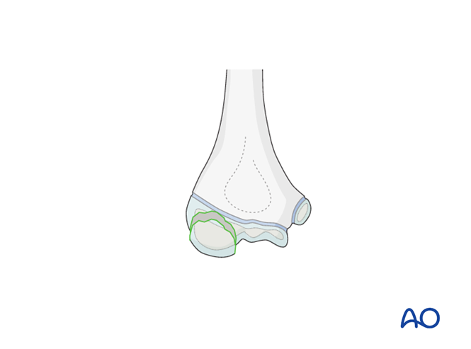 Simple intraarticular flake