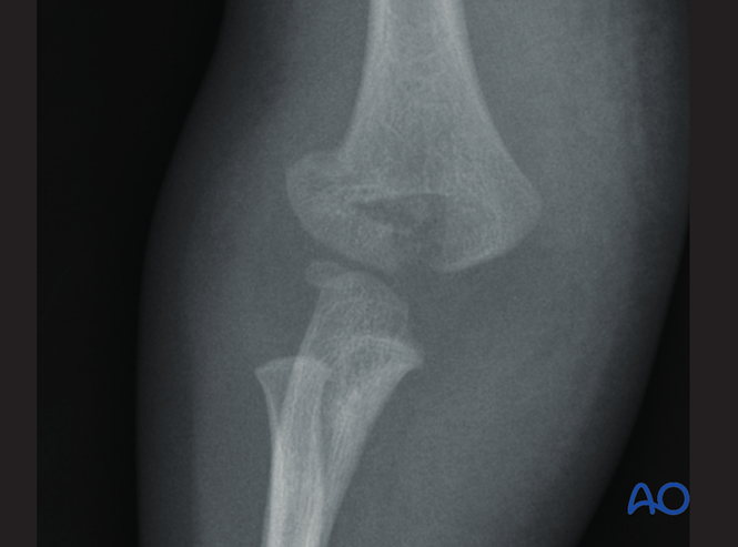 Simple epiphysiolysis with metaphyseal wedge, SH II