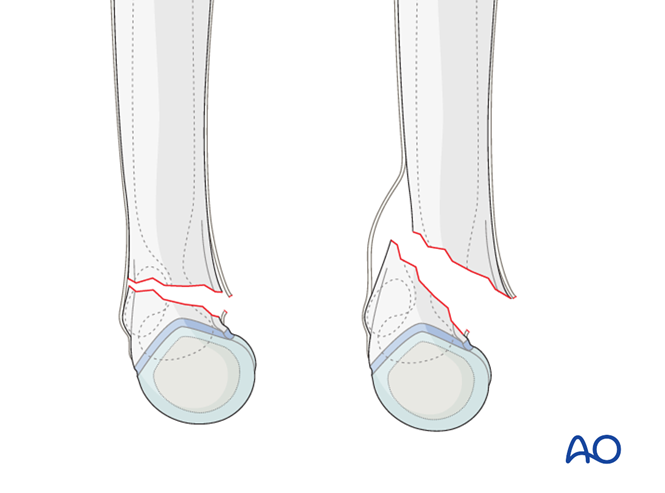 Open Reduction K Wire Fixation For Simple Metaphyseal Complete With