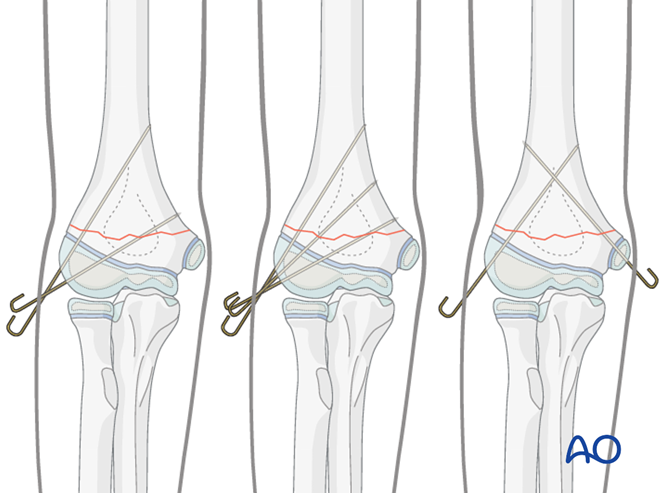 Open Reduction K Wire Fixation For Simple Metaphyseal Complete With