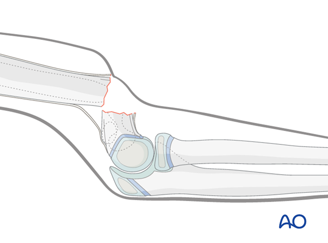 Closed reduction; K-wire fixation for Simple metaphyseal, complete with ...