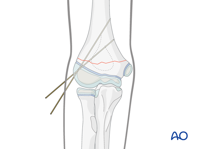 Closed Reduction K Wire Fixation For Simple Metaphyseal Complete With