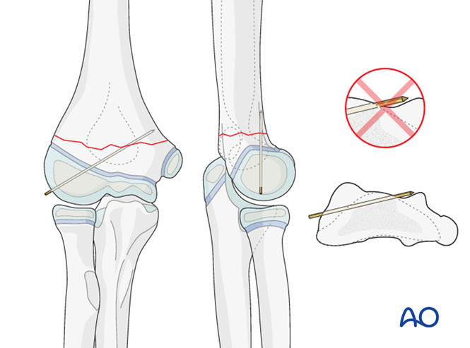 Open reduction; K-wire fixation for Simple metaphyseal, complete with ...