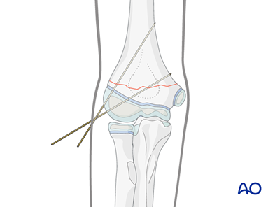 Closed reduction; K-wire fixation for Simple metaphyseal, complete with ...