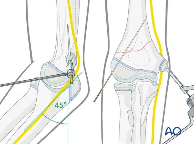 Open Reduction K Wire Fixation For Simple Metaphyseal Complete With