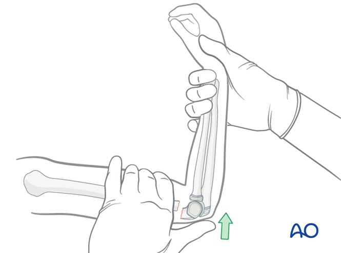 Closed reduction; K-wire fixation for Simple metaphyseal, complete with ...