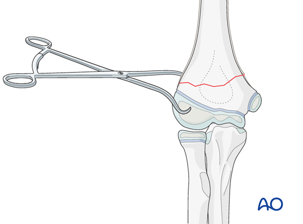 Open Reduction K Wire Fixation For Simple Metaphyseal Complete With