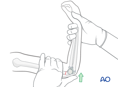 Closed reduction; splint immobilization for Simple metaphyseal ...