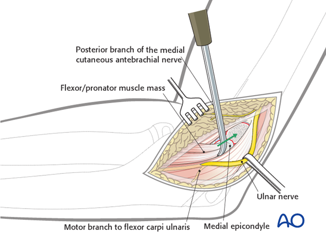 Open medial epicondylar reduction and internal fixation for Avulsion of ...