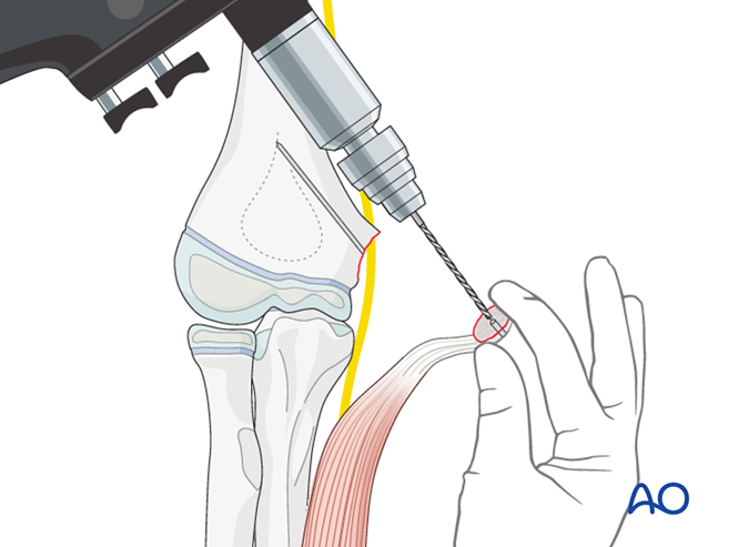 Open medial epicondylar reduction and internal fixation for Avulsion of ...