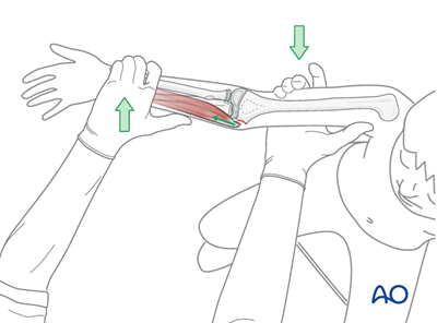Closed elbow reduction; splint immobilization for Avulsion of the ...