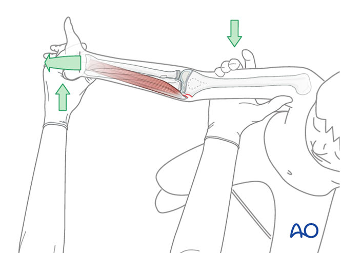 Closed elbow reduction; splint immobilization for Avulsion of the ...