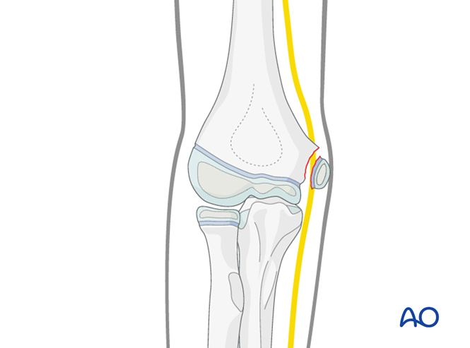 Closed elbow reduction; splint immobilization for Avulsion of the ...