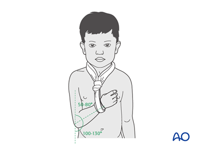 Collar and cuff immobilization for Simple metaphyseal, incomplete ...