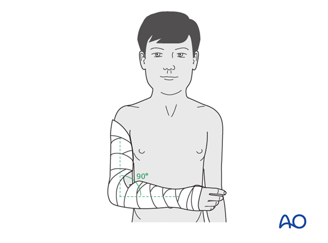 Closed reduction; splint immobilization for Simple metaphyseal ...