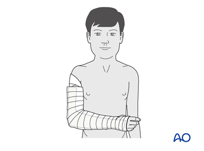 Closed elbow reduction; splint immobilization for Avulsion of the ...