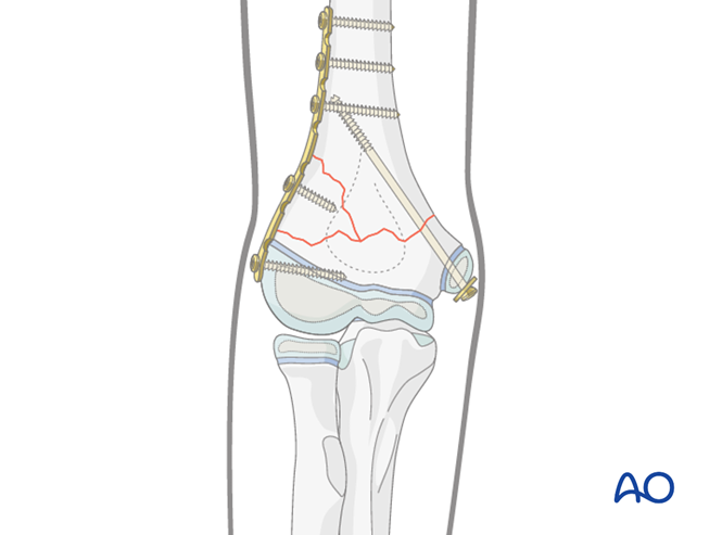Open reduction; internal fixation for Multifragmentary metaphyseal ...