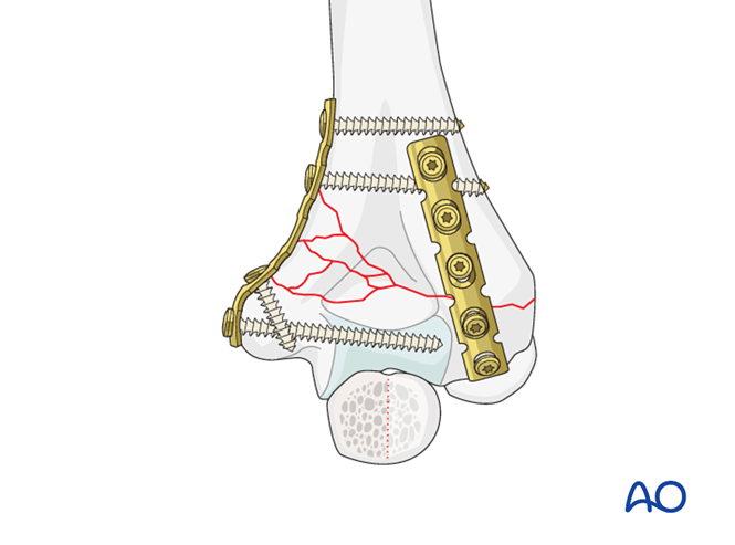 Open reduction; internal fixation for Multifragmentary metaphyseal ...