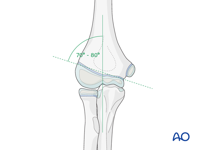 Open reduction; internal fixation for Multifragmentary metaphyseal ...