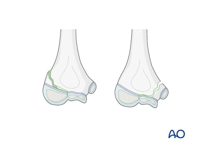 Cast immobilization for Simple epi-/metaphyseal, lateral condyle, SH IV