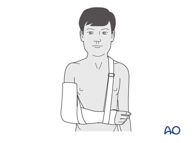 Cast immobilization for Simple epiphyseal, SH III