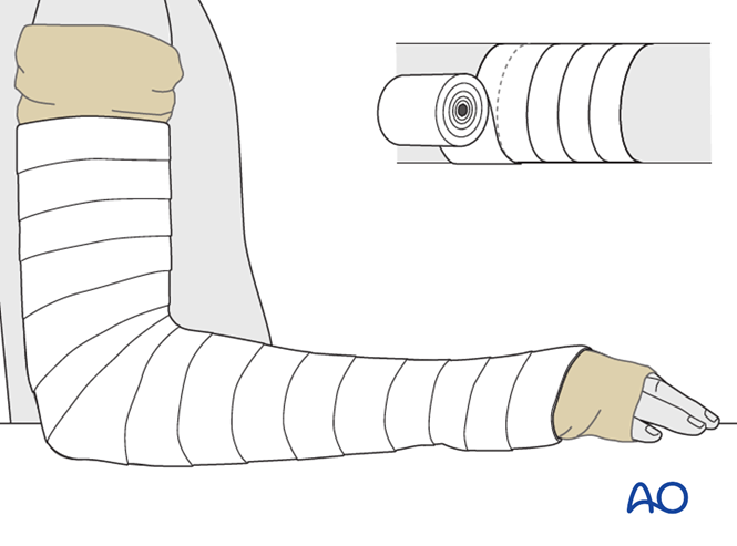 Cast immobilization for Avulsion of/by the lateral collateral ligament
