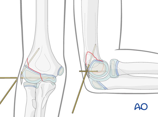 Closed indirect reduction, K-wire fixation for Simple epi-/metaphyseal ...