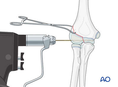 Open reduction; K-wire fixation for Simple epi-/metaphyseal, lateral ...