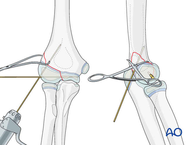 Open reduction; K-wire fixation for Simple epi-/metaphyseal, lateral ...