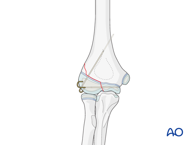 Open reduction; K-wire fixation for Simple epi-/metaphyseal, lateral ...