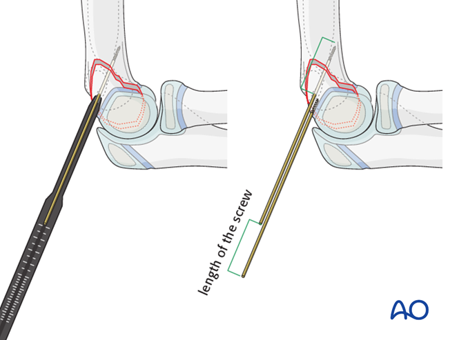 Open reduction; screw fixation for Simple epi-/metaphyseal, lateral ...
