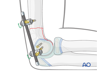 Open reduction; screw and external fixator for Multifragmentary epi ...