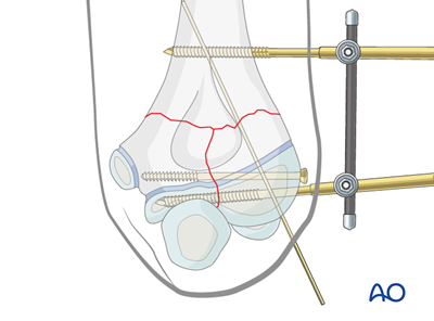 Open reduction; screw and external fixator for Multifragmentary epi ...