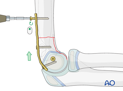 Open reduction; screw and plate fixation for Multifragmentary epi ...