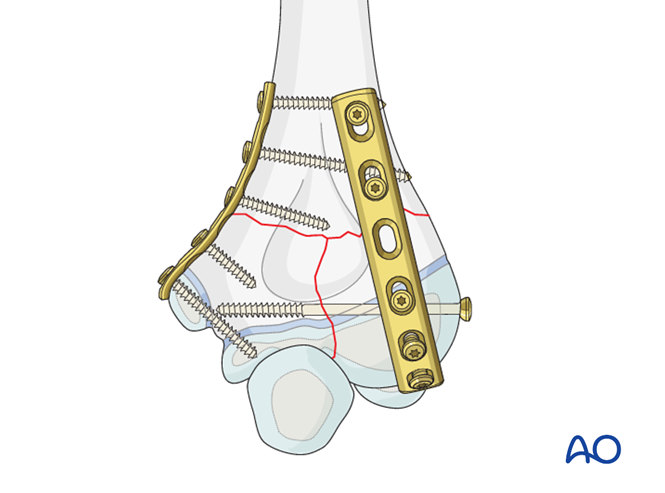 Open reduction; screw and plate fixation for Multifragmentary epi ...