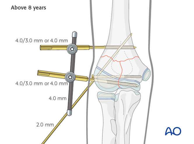 Open reduction; screw and external fixator for Multifragmentary epi ...